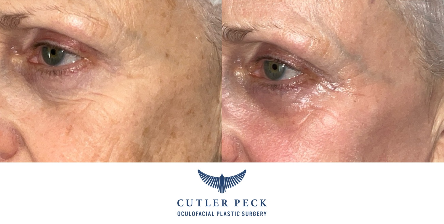 UltraClear Laser | Dr. Cutler Peck