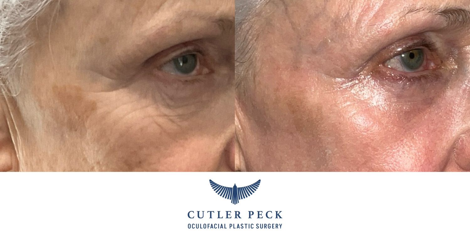 UltraClear Laser | Dr. Cutler Peck