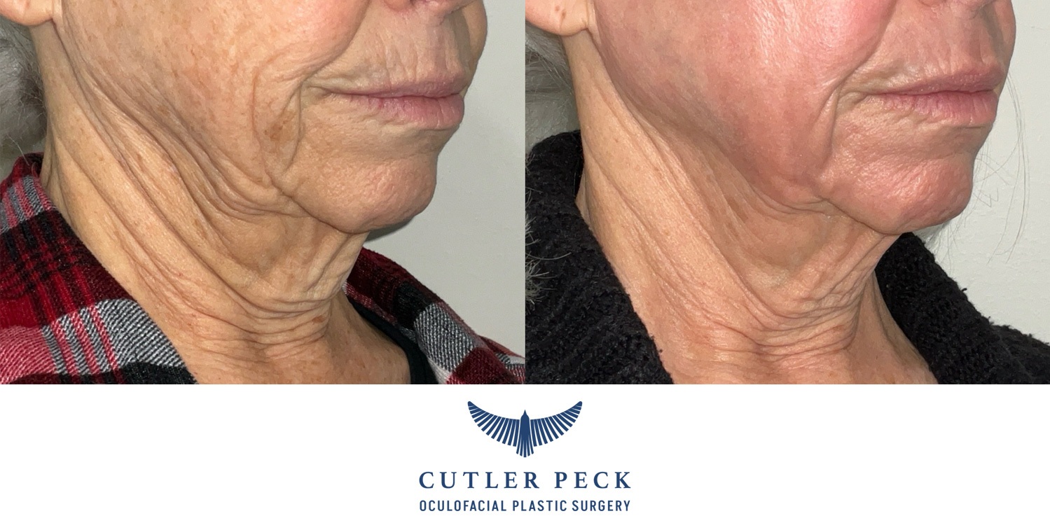 UltraClear Laser | Dr. Cutler Peck