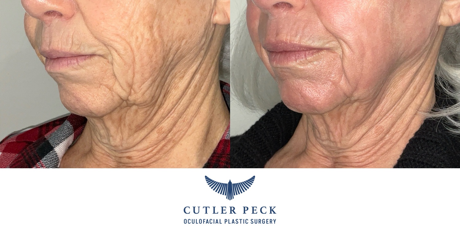 UltraClear Laser | Dr. Cutler Peck