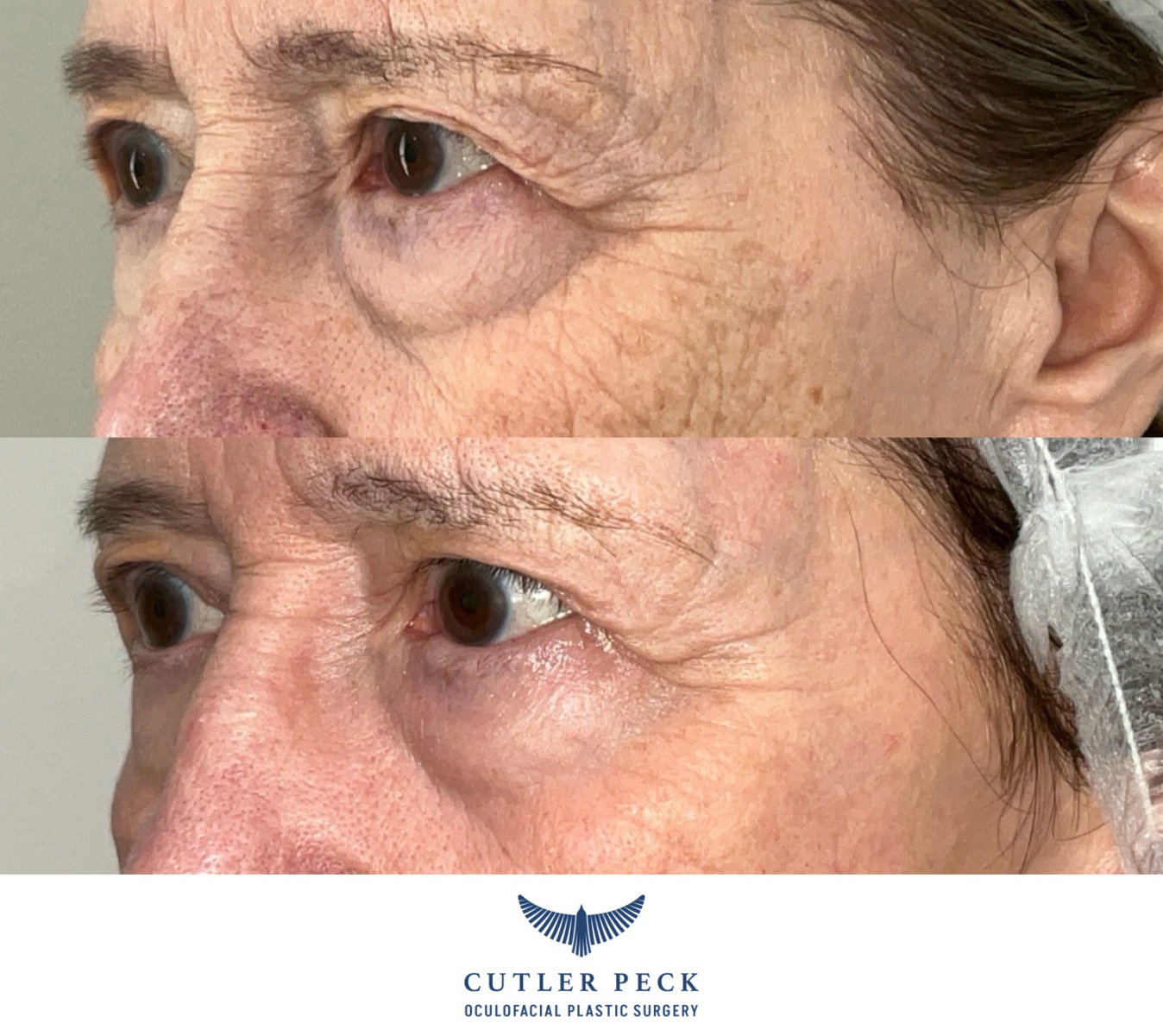 UltraClear Laser | Dr. Cutler Peck