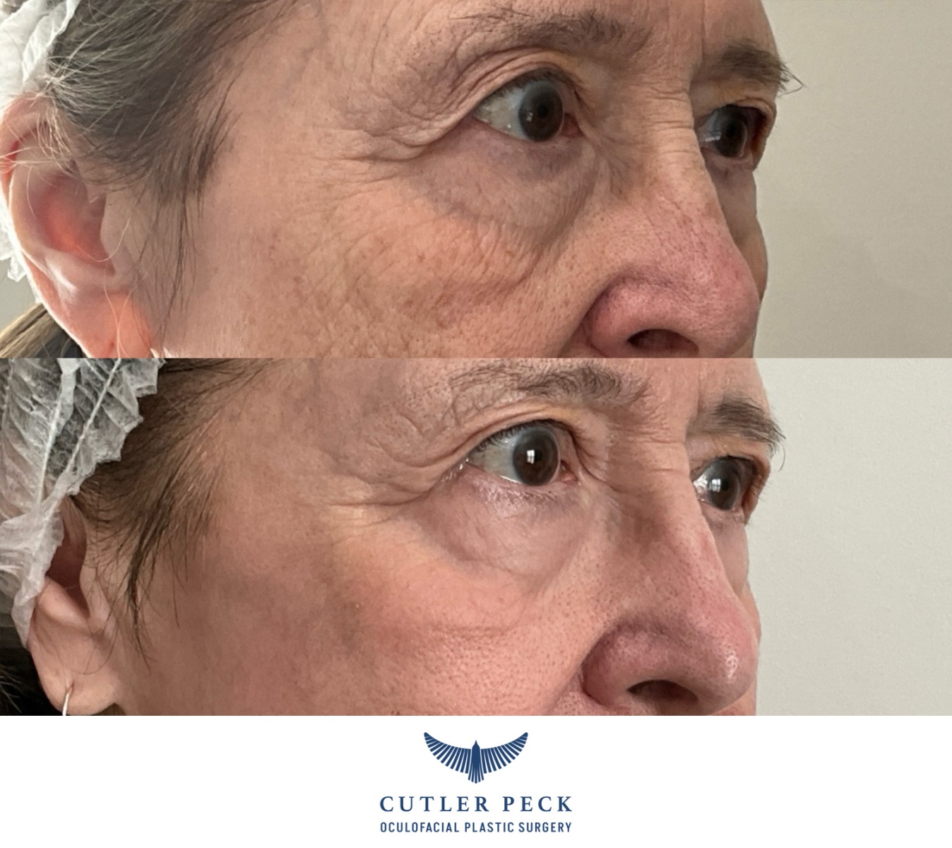 UltraClear Laser | Dr. Cutler Peck