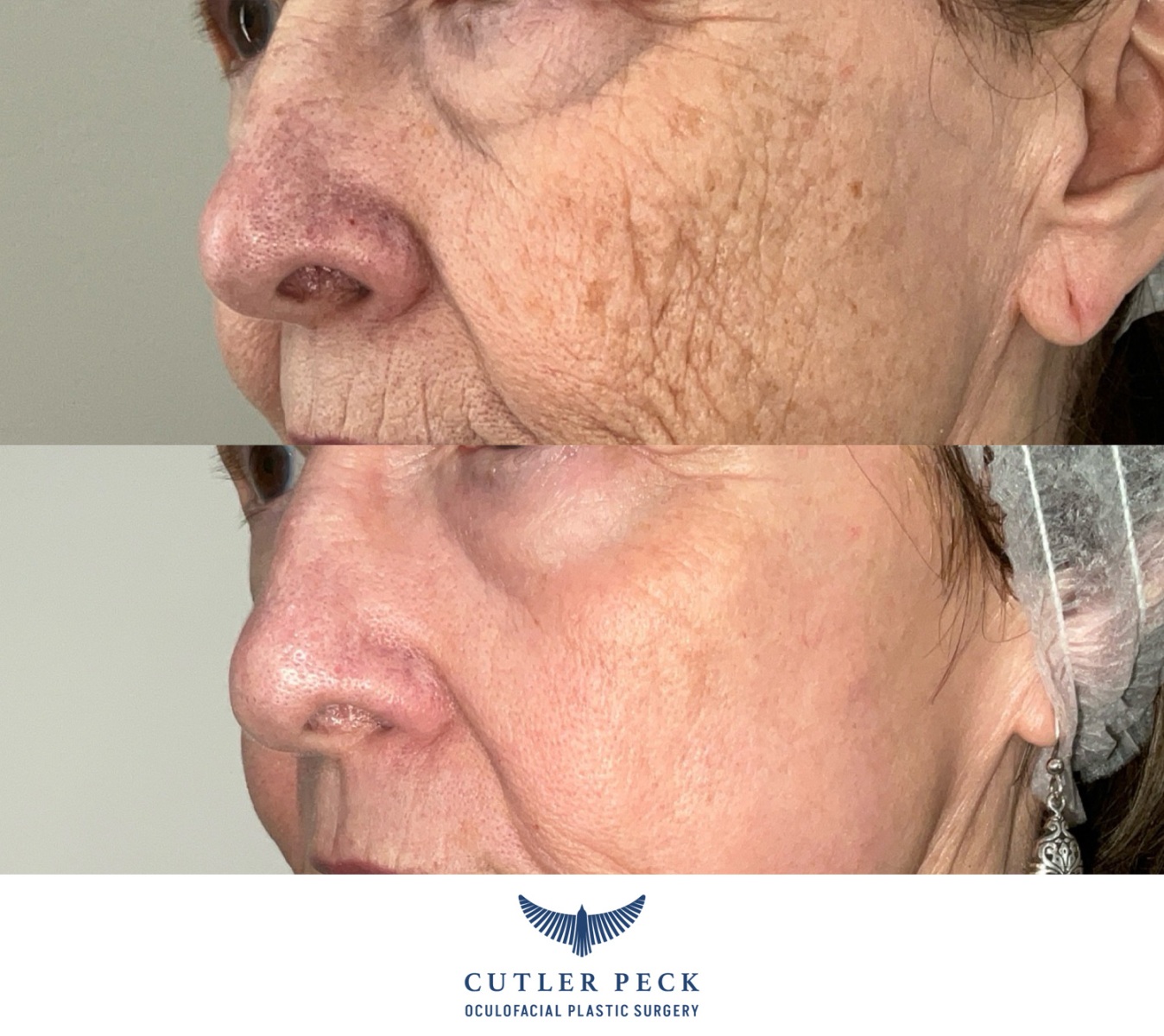 UltraClear Laser | Dr. Cutler Peck