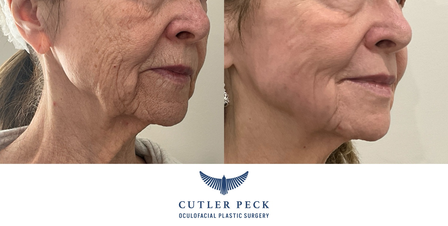 UltraClear Laser | Dr. Cutler Peck