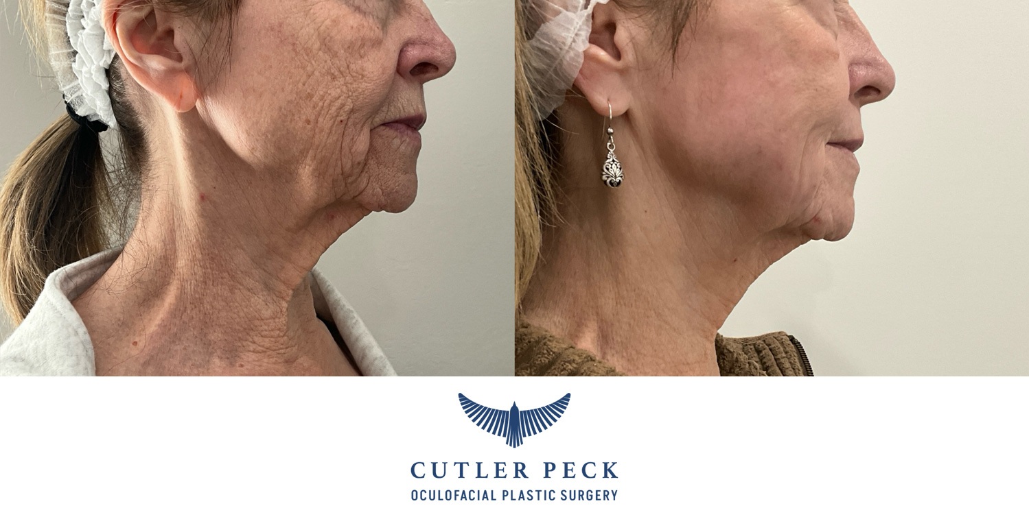 UltraClear Laser | Dr. Cutler Peck