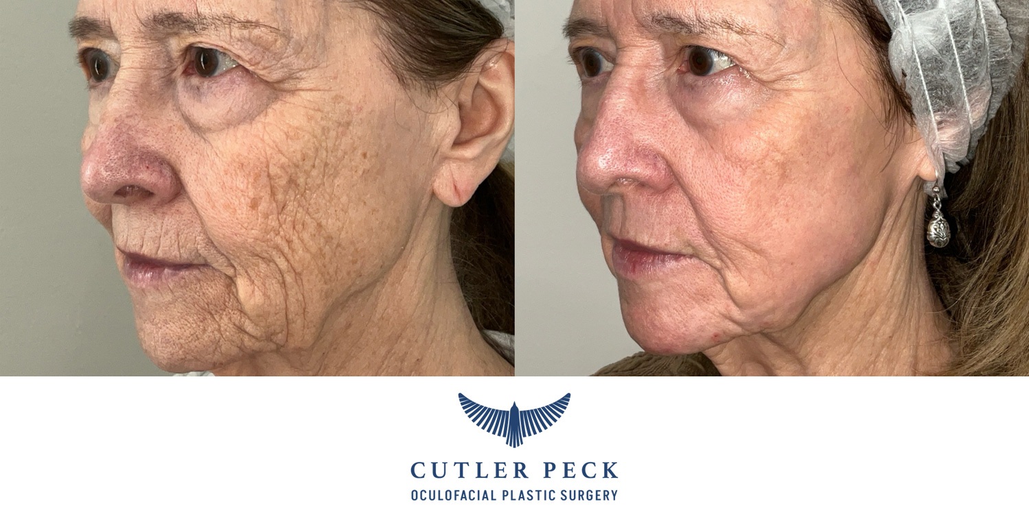 UltraClear Laser | Dr. Cutler Peck