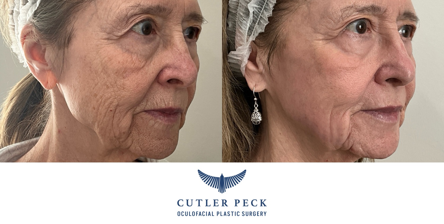 UltraClear Laser | Dr. Cutler Peck