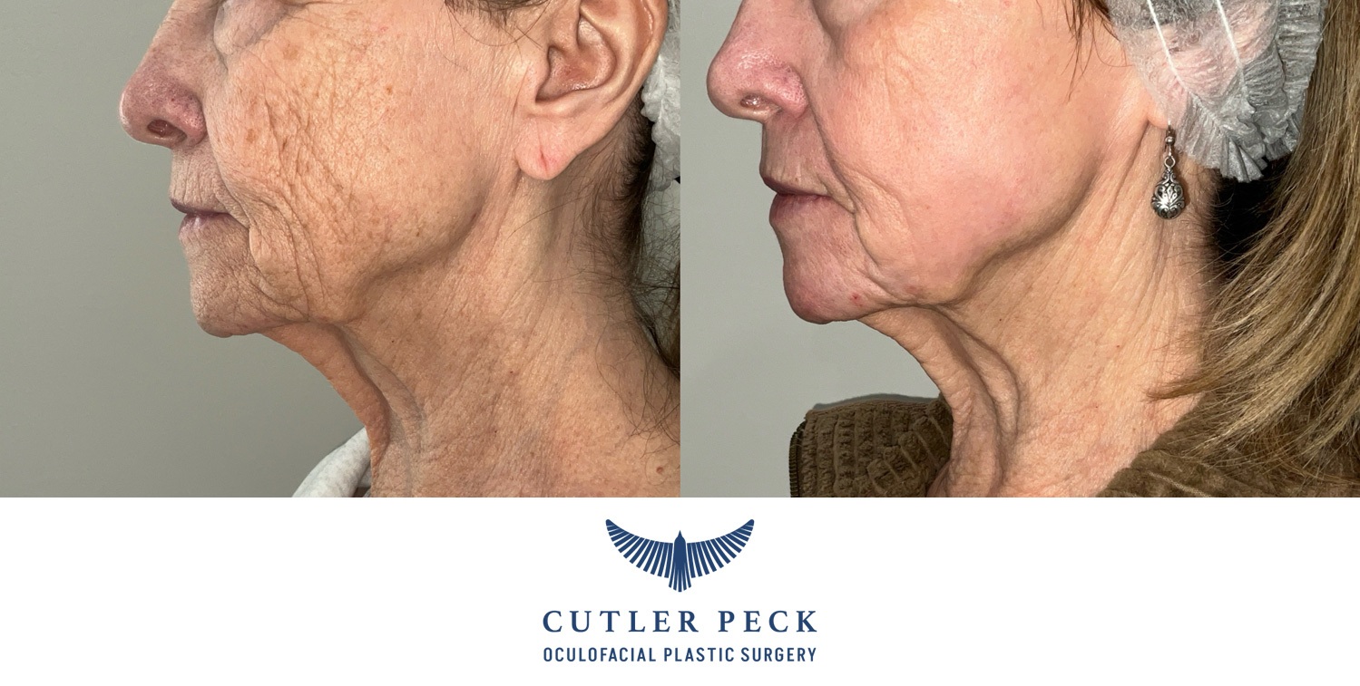 UltraClear Laser | Dr. Cutler Peck