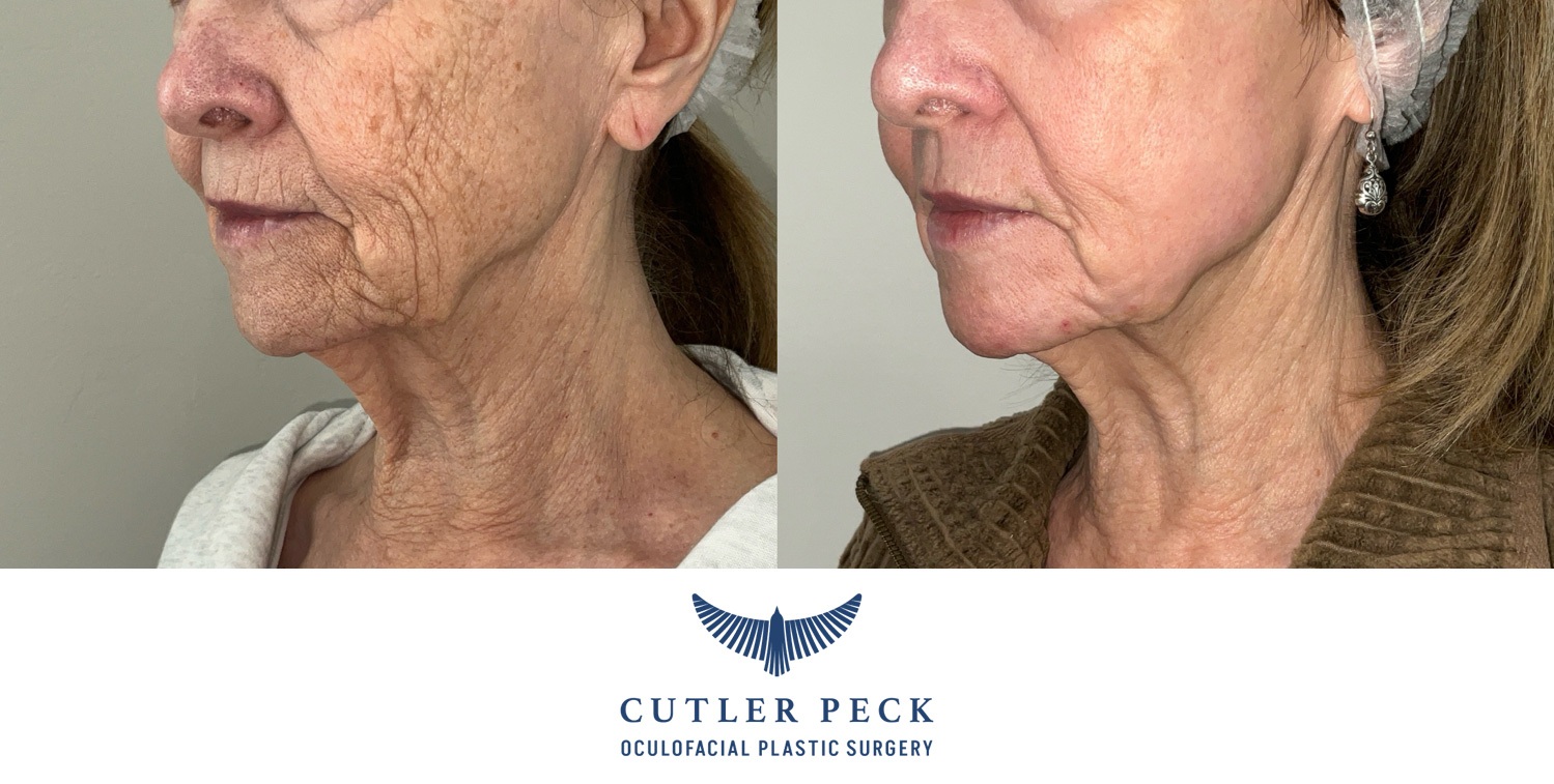 UltraClear Laser | Dr. Cutler Peck