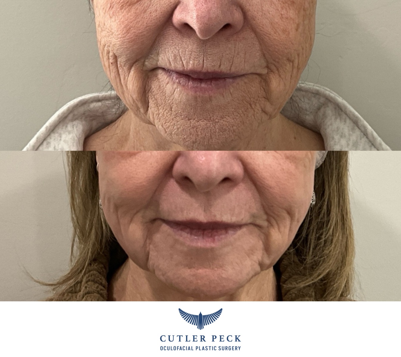 UltraClear Laser | Dr. Cutler Peck