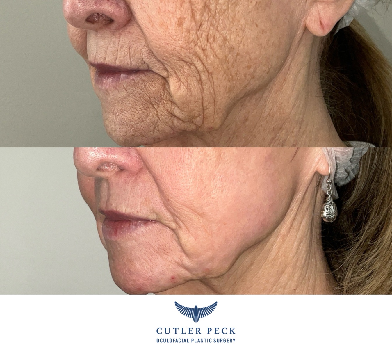 UltraClear Laser | Dr. Cutler Peck