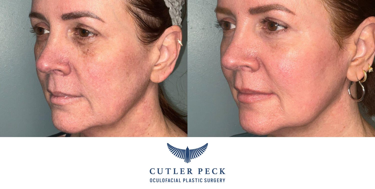 Before and After Photo Gallery | Dr. Cutler Peck