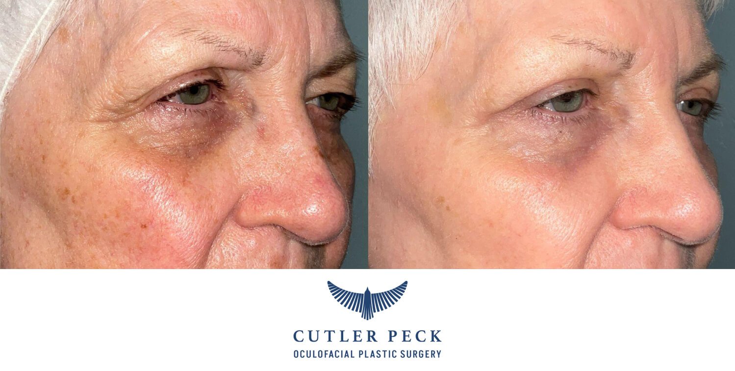 Before and After Photo Gallery | Dr. Cutler Peck