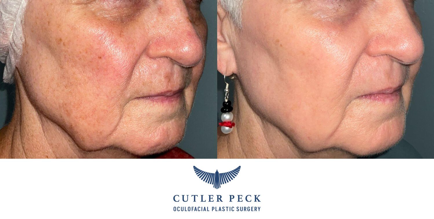 Before and After Photo Gallery | Dr. Cutler Peck