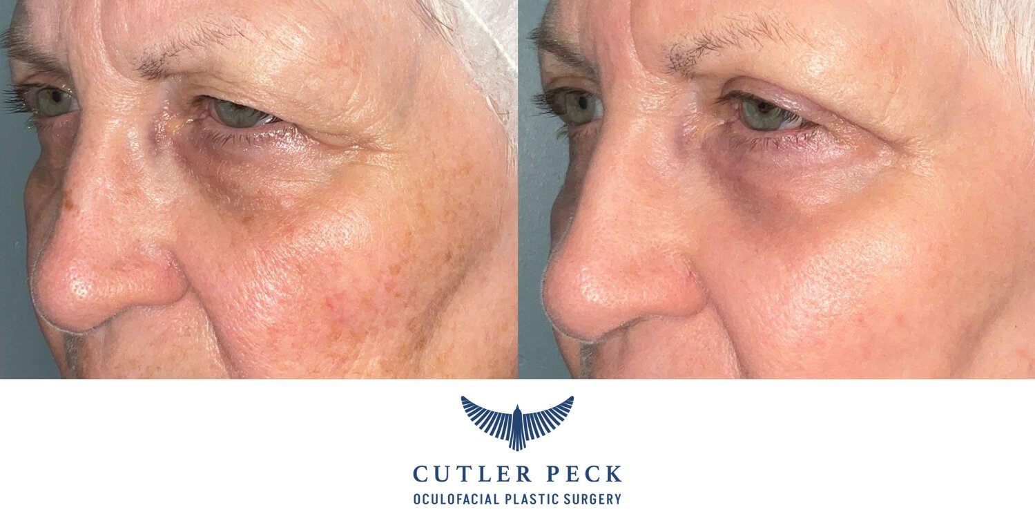 Before and After Photo Gallery | Dr. Cutler Peck