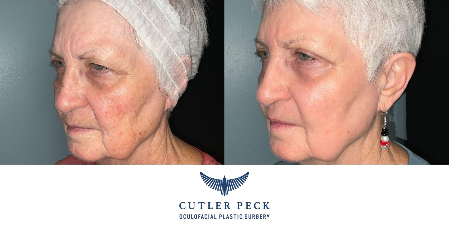 UltraClear Laser | Dr. Cutler Peck