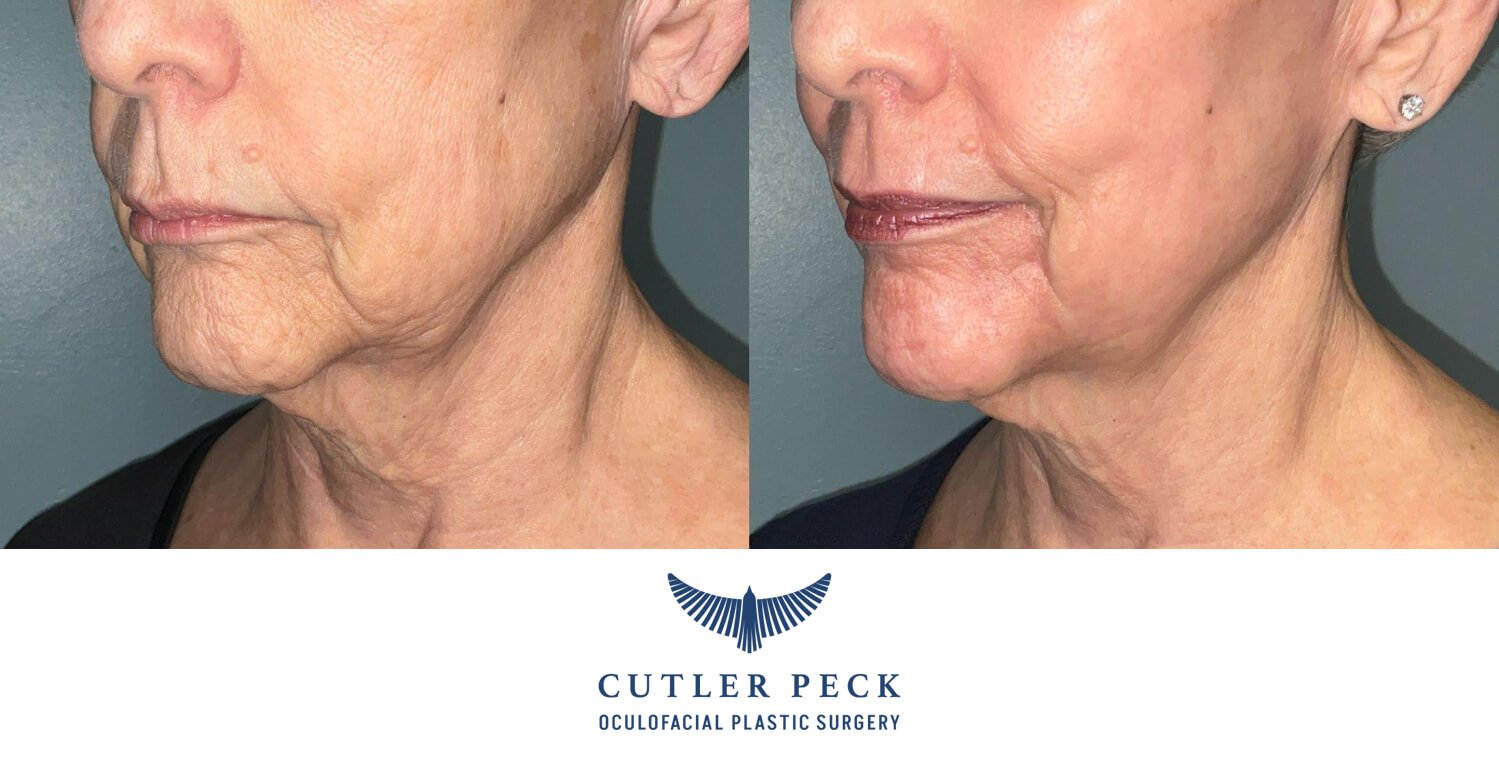 UltraClear Laser | Dr. Cutler Peck