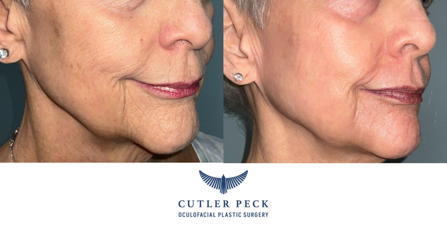 UltraClear Laser | Dr. Cutler Peck