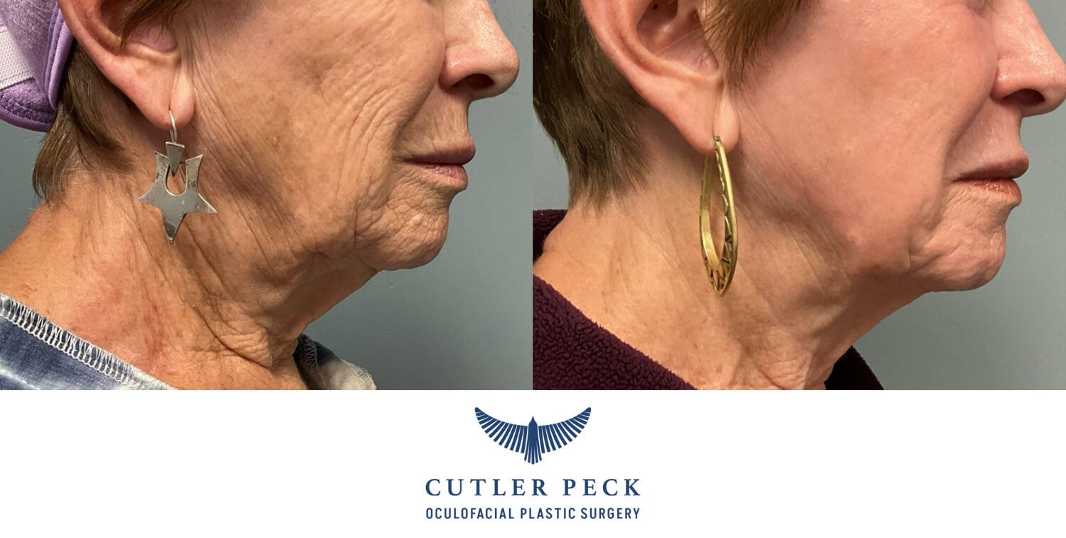 Before and After Photo Gallery | Dr. Cutler Peck