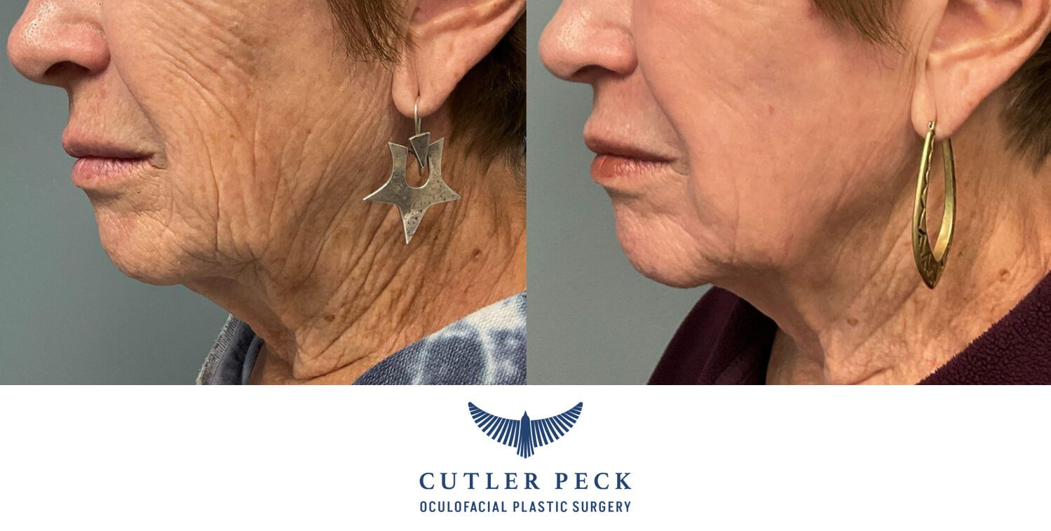 UltraClear Laser | Dr. Cutler Peck