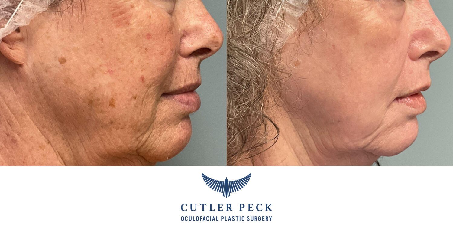 UltraClear Laser | Dr. Cutler Peck