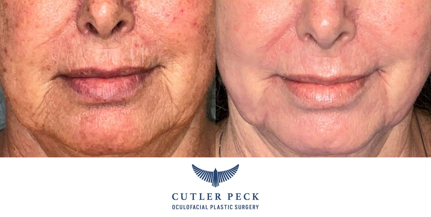 Before and After Photo Gallery | Dr. Cutler Peck