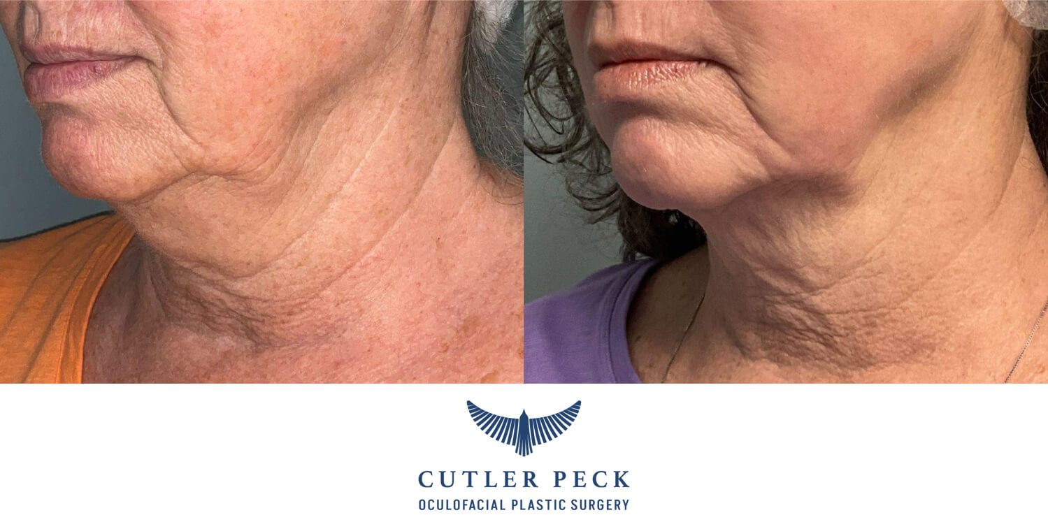 UltraClear Laser | Dr. Cutler Peck