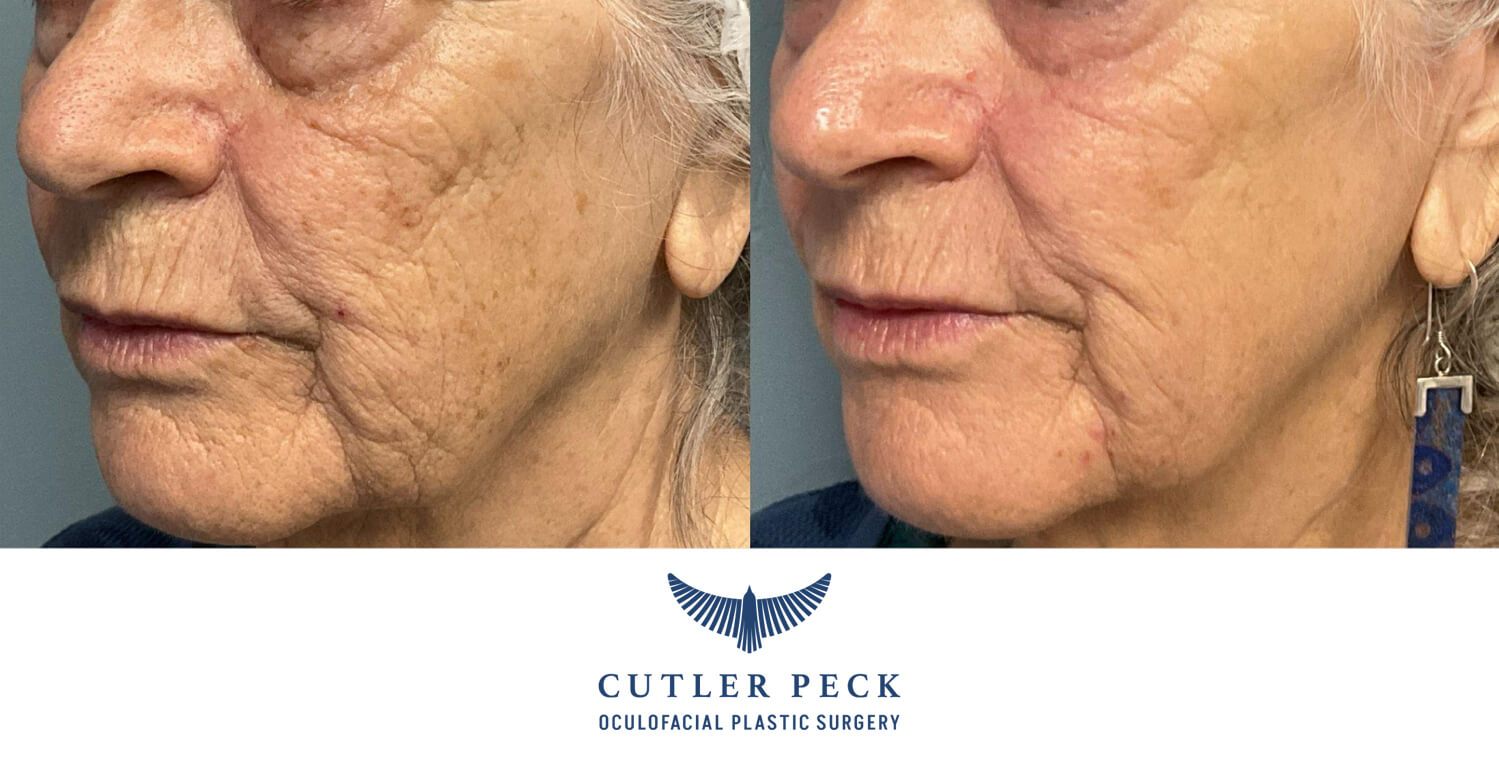 Before and After Photo Gallery | Dr. Cutler Peck