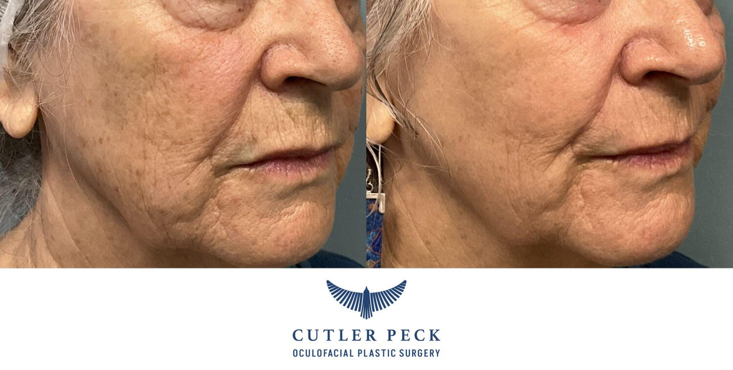 Before and After Photo Gallery | Dr. Cutler Peck