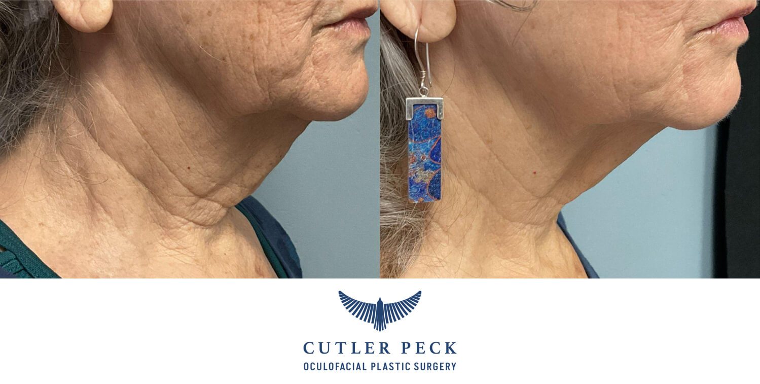 UltraClear Laser | Dr. Cutler Peck