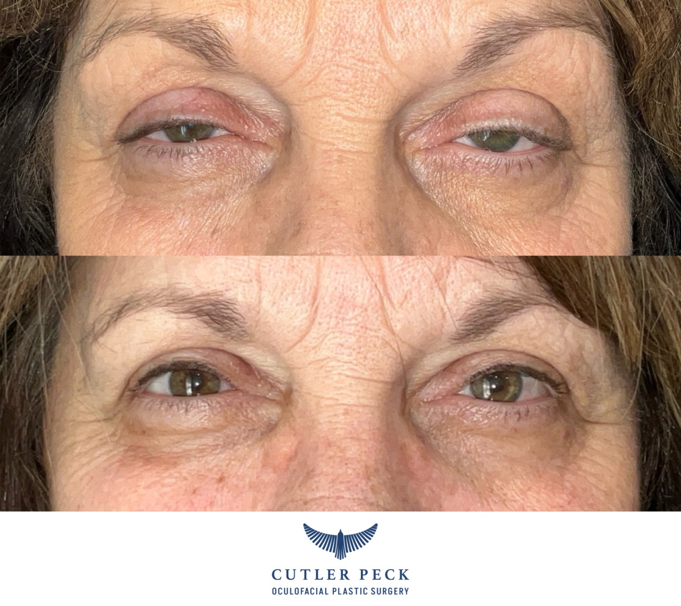 Upper Eyelid Ptosis Repair | Dr. Cutler Peck
