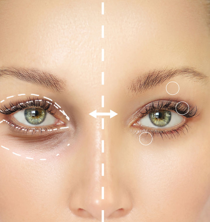 Eyelid Surgery Idaho Falls | Oculoplastic Surgeon Rexburg. ID