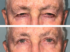 Male Blepharoplasty | Dr. Cutler Peck