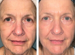 UltraClear Laser Idaho Falls | Dr. Cutler Peck