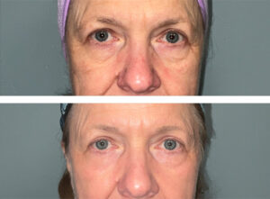 UltraClear Laser Idaho Falls | Dr. Cutler Peck