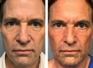 UltraClear Laser Idaho Falls | Dr. Cutler Peck