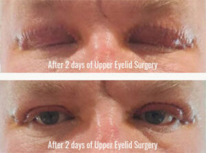 Male Blepharoplasty | Dr. Cutler Peck